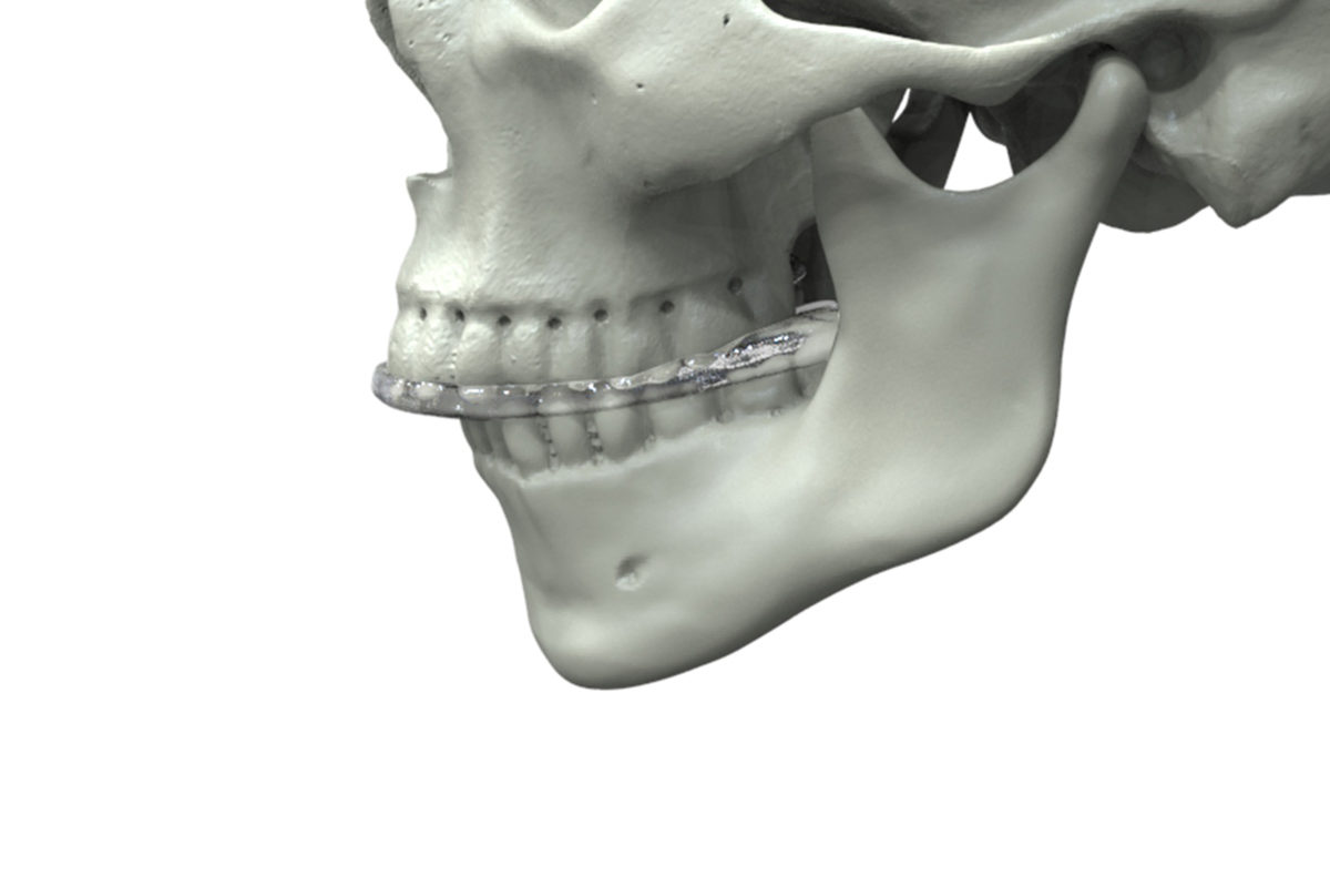Customized Models - SYNBONE